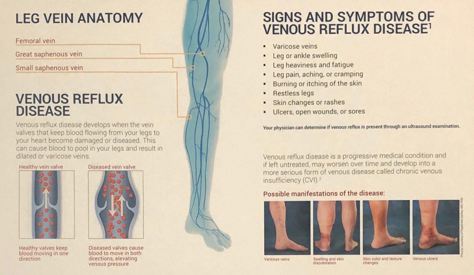 How to Get Rid of Varicose Veins - Cardiovascular Consultants